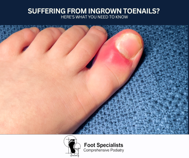 Suffering From Ingrown Toenails? Here's What You Need to Know ...